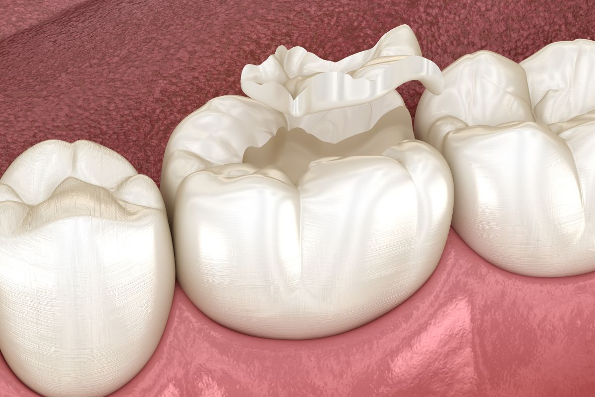 How to Repair a Cracked Tooth at Home
